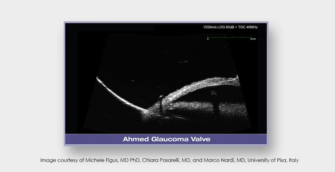 Ellex Eye Cubed™ Ophthalmic Ultrasound