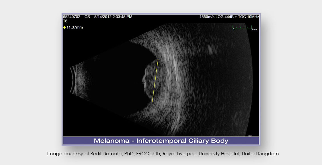 Ellex Eye Cubed™ Ophthalmic Ultrasound