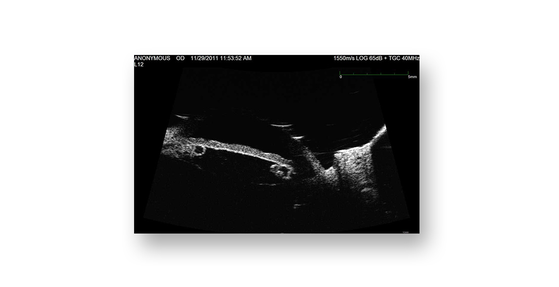 Ellex Eye Cubed™ Ophthalmic Ultrasound